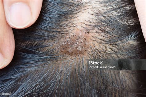 Dermatitis Pada Rambut Atau Penyakit Kulit Di Kepala Foto Stok Unduh