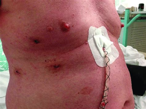 Position Of The Subxiphoid Utility Incisions And The Other Three 5 Mm Download Scientific