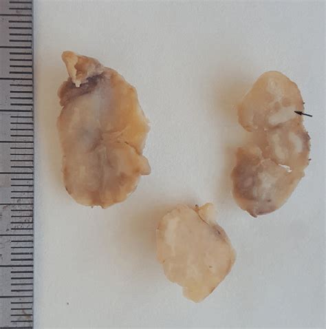 Macroscopic View An Illustrative Case Of Lymph Node Tuberculosis With Download Scientific