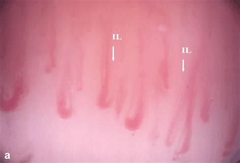 Nailfold Capillaroscopy ×200 A Increased Length Il Of