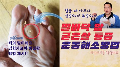 발바닥 굳은살 티눈 원인과 통증 해소하는 운동법과 신발 선택법지간신경종 예방 확실 무지외반 메커니즘과 동일 Youtube