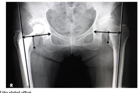Hip Arthritis Leg Length Discrepancy At Margaret Cass Blog