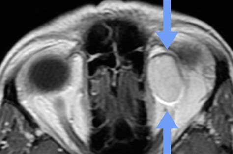 Morie Artifact Mri