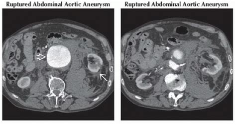 Da15 Db1 Perirenal Hemorrhage Ffu4  Abdominal Key