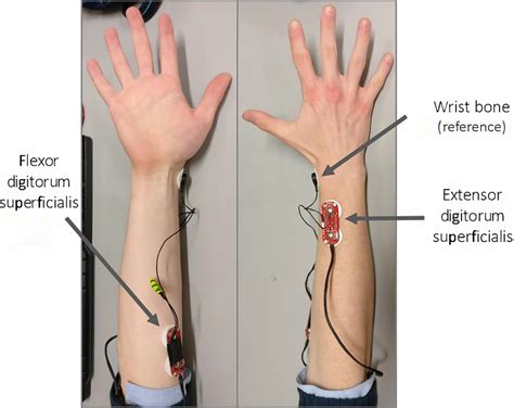 The Figure Shows The Position Of The Semg Sensors On A Healthy Subject Download Scientific