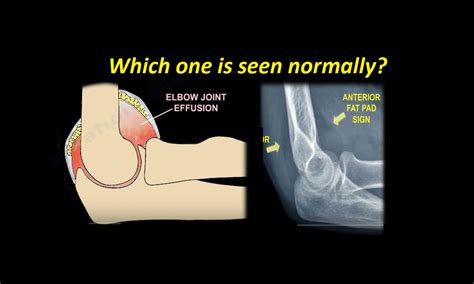 Occult Injury Of The Elbow And Joint Effusion —