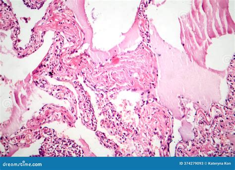 Lobar Pneumonia During The Hemorrhagic Edema Period Light Micrograph