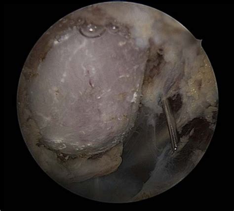 Figure 1 From Functional Outcomes After Arthroscopic Scapulothoracic Bursectomy And Partial
