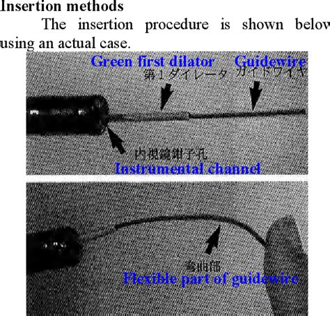 PDF 3 Endoscopic Decompression Of Carcinoma Ileus Of The Left Colon Semantic Scholar