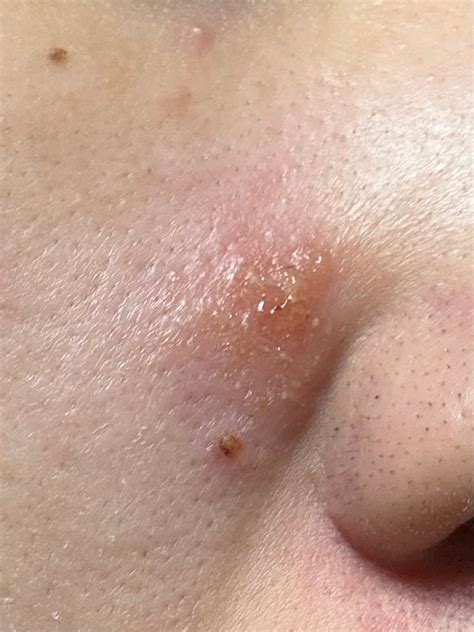 피부 여드름 질환 질문 도와주세요 지식in