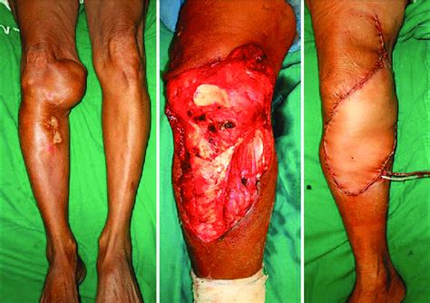 Recurrent Synovial Sarcoma Of The Leg Treated With Wide Excision And