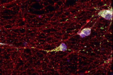 Pre Birth Onset Of Fragile X Syndrome Unveiled