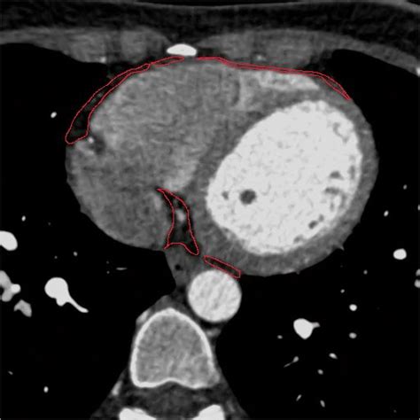 Epicardial Fat Segmentation A And B Input Image Slice With Download Scientific Diagram