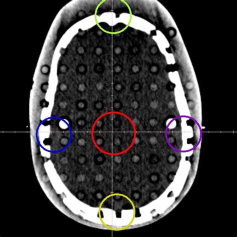 PDF Effects Of The Difference In Tube Voltage Of The CT Scanner On Dose Calculation