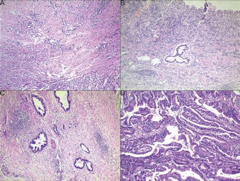 Ca724 Predicts Tumor Regression Grade In Locally Advanced Gastric
