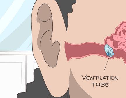 3 Ways To Unplug Ears WikiHow
