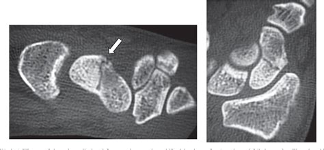 Figure 1 From Undisplaced Scaphoid Waist Fractures Is 4 Weeks Immobilisation In A Below Elbow