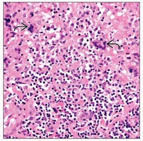 Wegener Granulomatosis Basicmedical Key