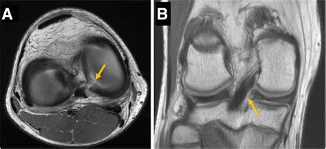 Transosseous Repair Of Isolated Posterior Medial Meniscal Root Injuries