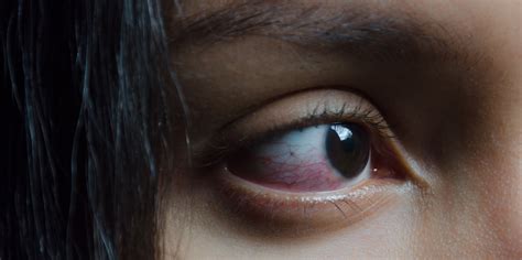 What Exactly Causes Red Eyes That Look All Bloodshot Self