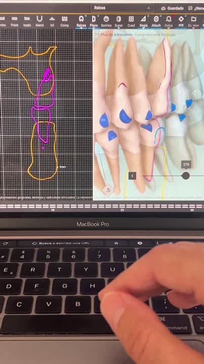 Smart Aligner Services On Linkedin Tip 43 Is Cbct Useful In A Crossbite