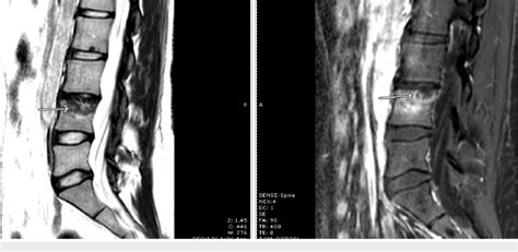 Initial Mri Lumbar Spine Magnetic Resonance Imaging Mri Sagittal View