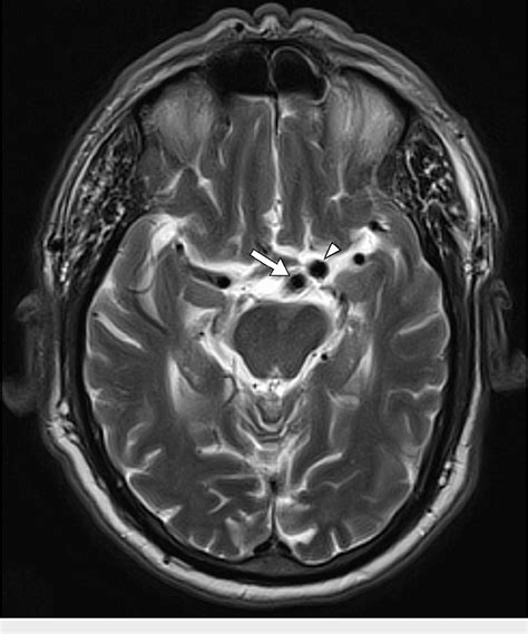 Figure 2 From Trigeminal Neuralgia And Hemifacial Spasms Due To