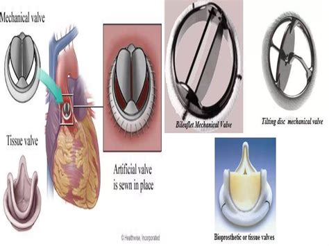 Mitral Valve Replacement Pptx