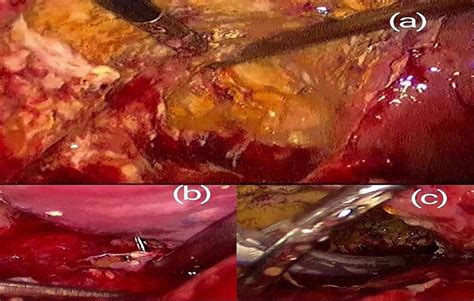 A Case Of Delayed Management Of Bdi A Shows A Chiba Needle Inserted