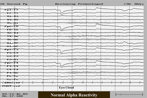Normal Eeg Patterns Frequencies As Well As Patterns That May Simulate