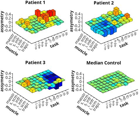 3d Sagittal Asymmetry Maps Show High Magnitude Of Asymmetry