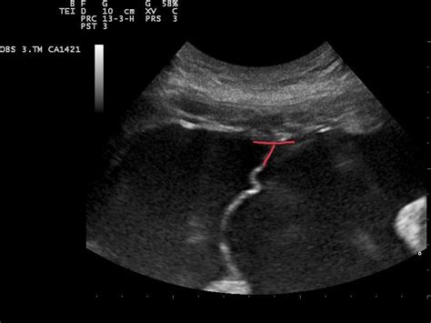 Twin Pregnancy Ultrasound Evaluation And Monitoring The Obg Project
