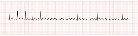 EKG Monitor Showing Atrial Flutter With To AV Block After Adenosine Intravenous