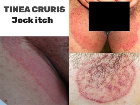 Jock Itch Tinea Cruris Symptoms Causes And Treatment