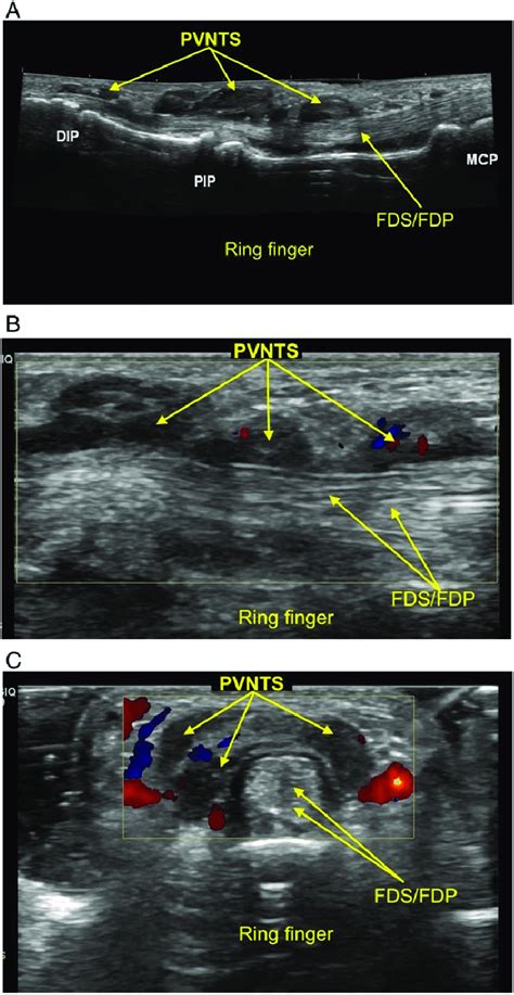 A Panoramic Ultrasound Imaging Hypoechoic Heterogeneous Solid Mass