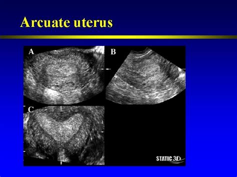 Ultrasonography In Management Of Subfertility Dr Ernest Hung
