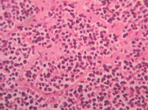 Ewings Sarcoma Primitive Or Peripheral Neuroectodermal Tumor Histopathology Guru