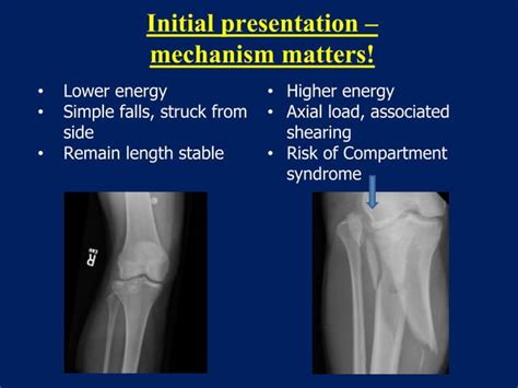 Proximal Tibia Fractures And Its Management Pptx