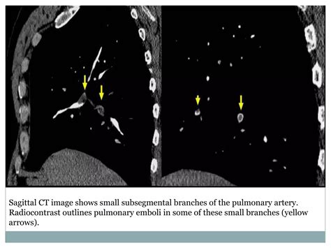 Pulmonary Embolism Radiology Pptx