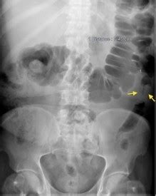 Large Bowel Obstruction Bowel Obstruction Causes Management