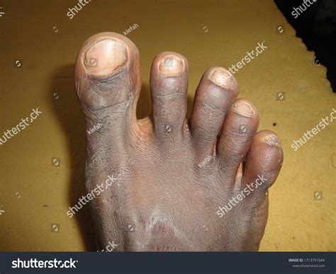 Black People Toenails