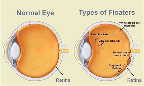 Eye Floaters Causes Symptoms And Treatment
