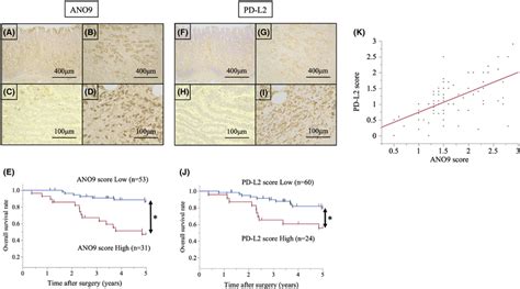 IHC Analysis Of Human Gastric Cancer GC Tissue A IHC Staining Of Download Scientific