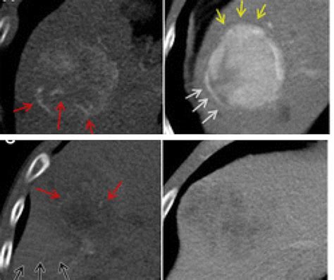Microvascular Invasion In Hepatocellular Carcinoma Can A Ct Radiomics Model Have An Impact