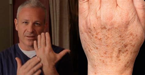 ეს ამერიკელი ექიმის მეთოდია რომელიც ნებისმიერ პიგმენტურ ლაქას მარტივად გაუმკლავდება