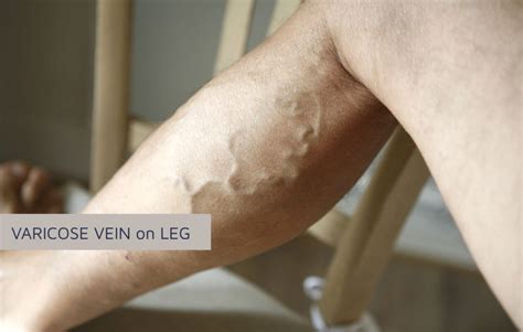 How Can A Venous Ultrasound Diagnose Poor Leg Circulation