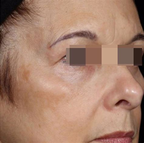 PICO Genesis SkinLab