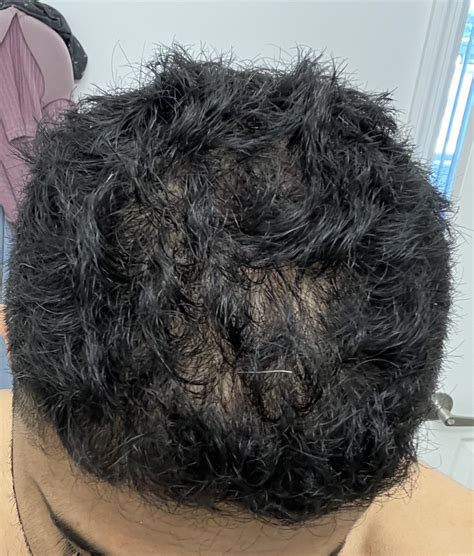 Am I Balding R Hairloss