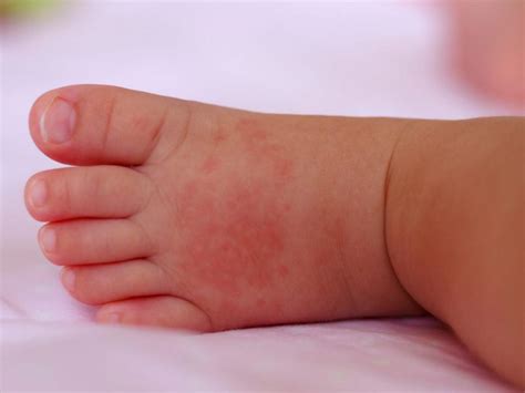 Экзема На Ногах Фото —