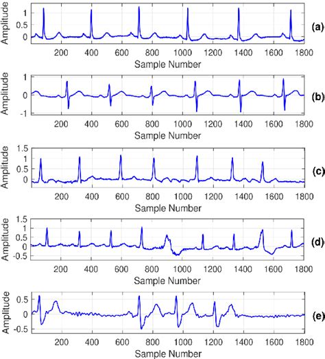 Figure 1 From Cnn Based Heart Rate Classification Using Ecg Signal
